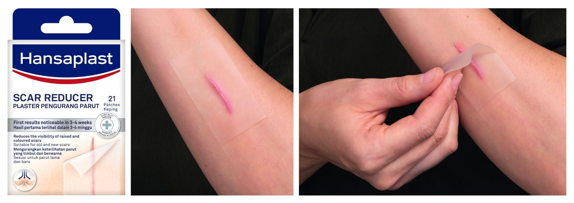 Hansaplast Scar Reducer: New Polyurethane Scar Patch - Mummyfique