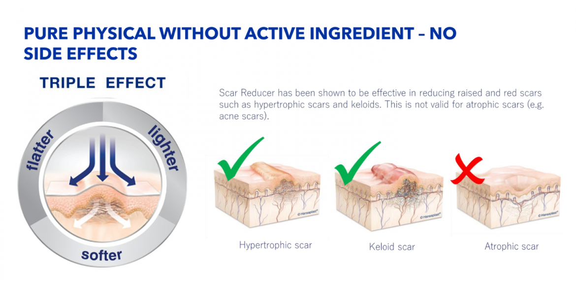 Hansaplast Scar Reducer: New Polyurethane Scar Patch - Mummyfique