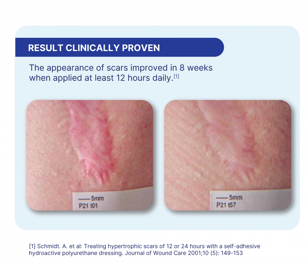 Hansaplast Scar Reducer: New Polyurethane Scar Patch - Mummyfique